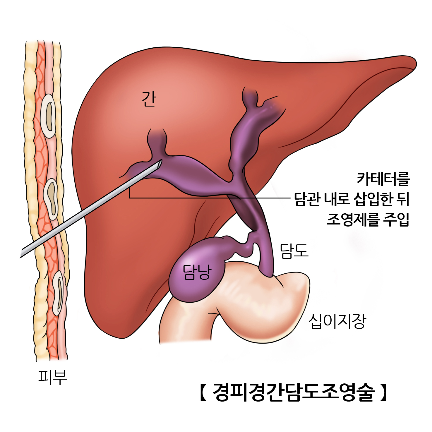 경피적 간담도조영술 검사시술수술 정보 의료정보 건강정보 서울아산병원