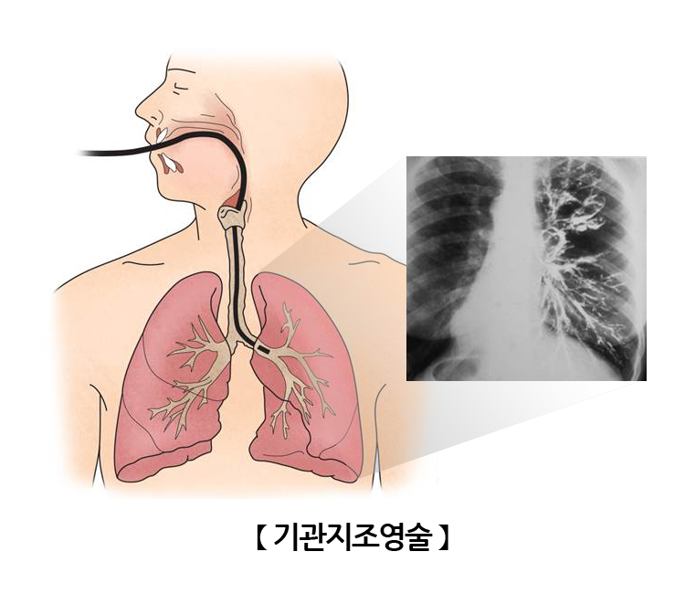 기관지조영술 검사시술수술 정보 의료정보 건강정보 서울아산병원